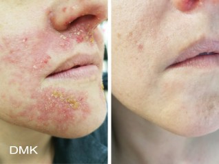 Reactive skin - DMK Results - DMKCustomer