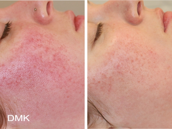 Reactive skin - DMK Results - DMKCustomer