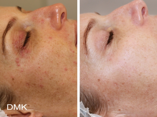 Reactive skin - DMK Results - DMKCustomer